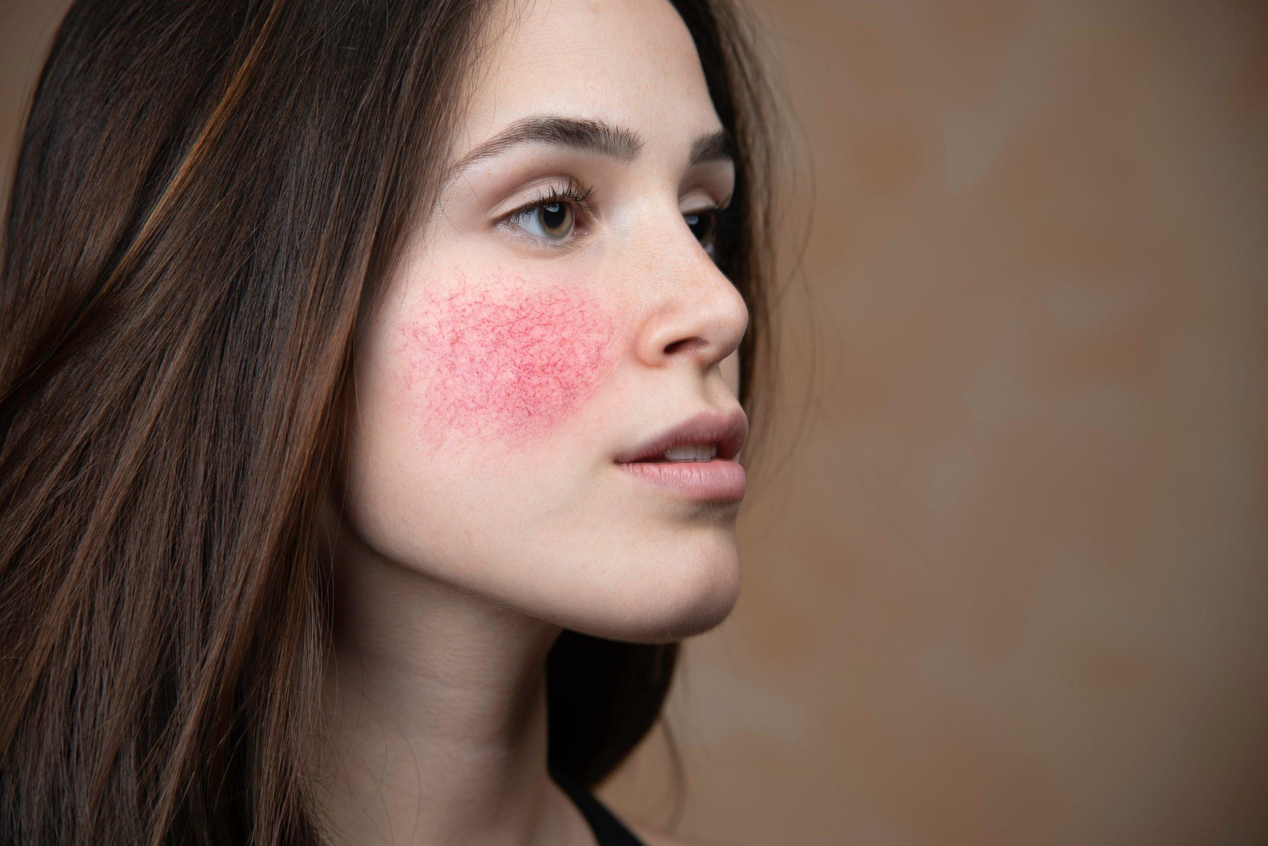 Rosacea - Healing Hub