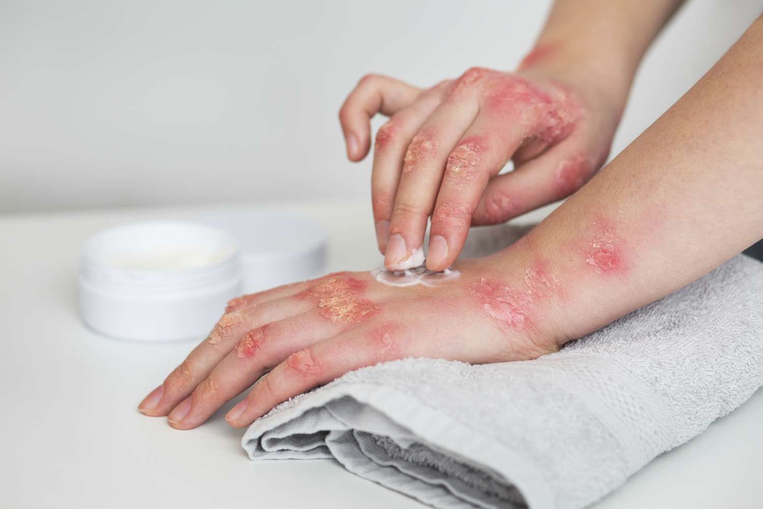 Psoriasis - Healing Hub